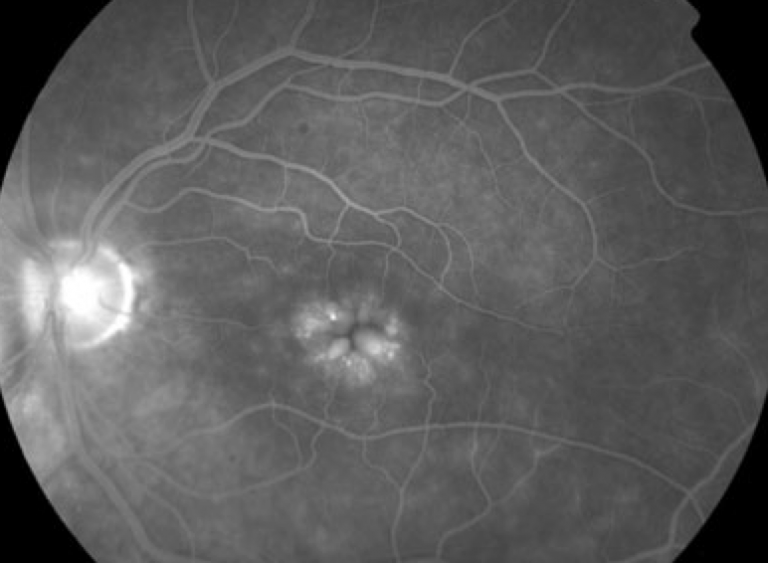 How to interpret fluorescein angiography: 6 types of defects - EyeGuru