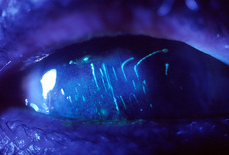 How to diagnose and manage corneal abrasions and bacterial ulcers - EyeGuru