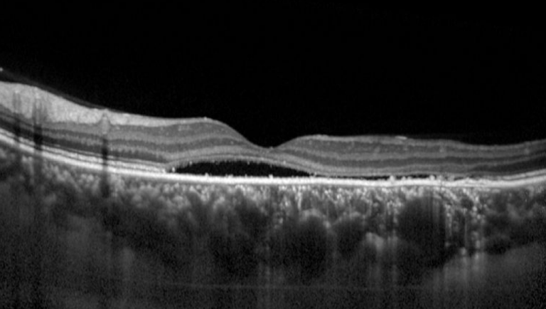How to read OCTs: 8 fundamental diseases - EyeGuru
