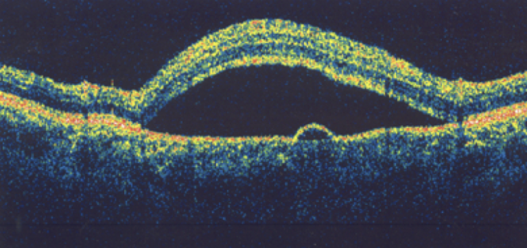 How to read OCTs: 8 fundamental diseases - EyeGuru