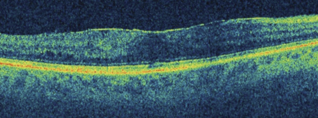 How to read OCTs: 8 fundamental diseases - EyeGuru