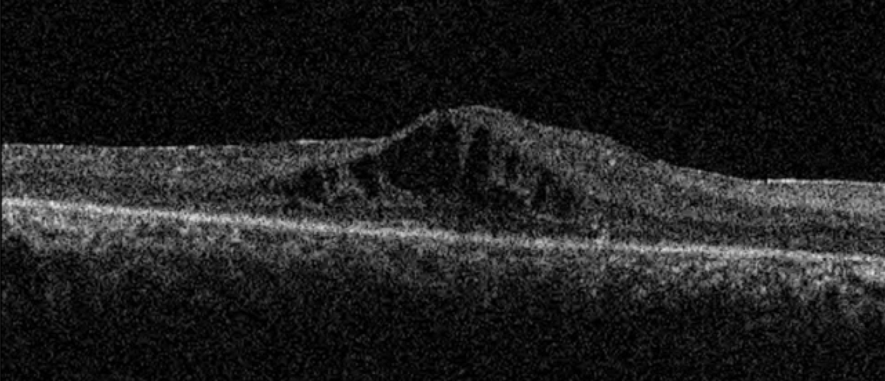 How to read OCTs: 8 fundamental diseases - EyeGuru