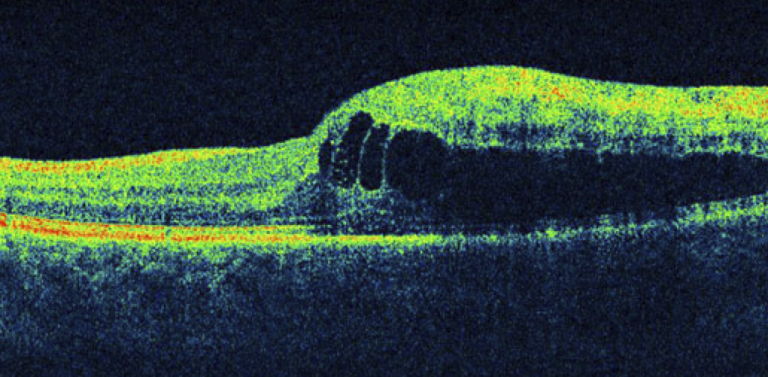 How to read OCTs: 8 fundamental diseases - EyeGuru