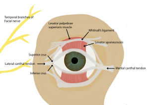How to perform a lateral canthotomy - EyeGuru